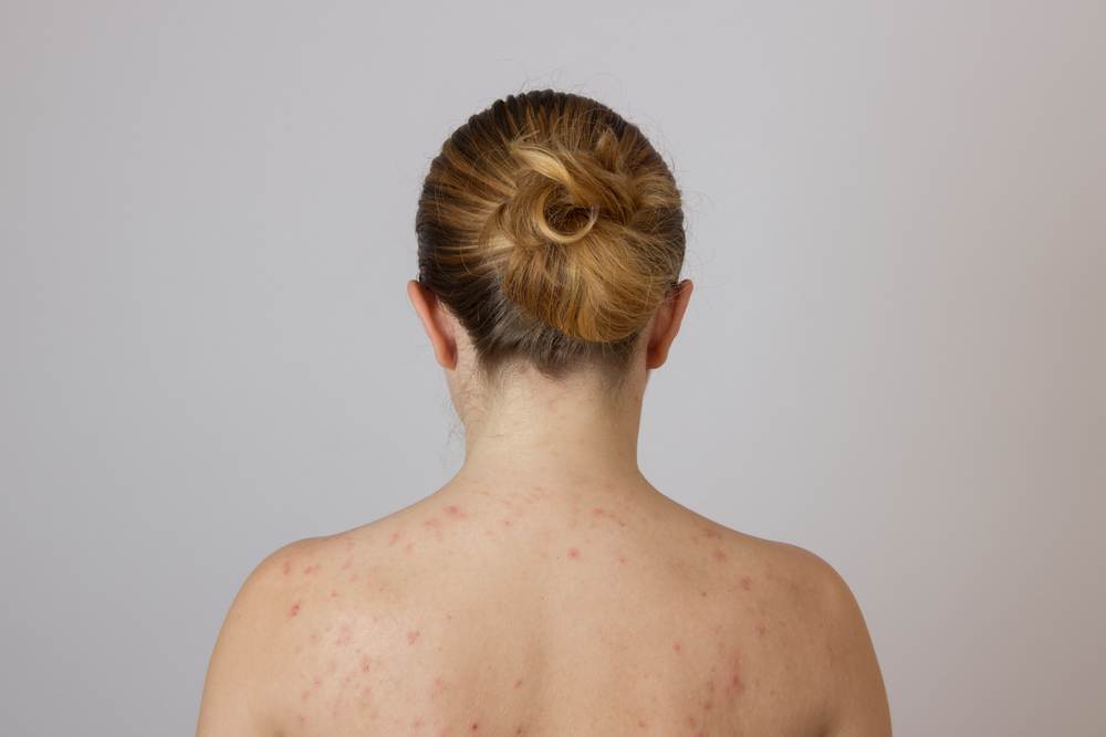 Miami Center for Cosmetic Dermatology – Dr. Deborah LongwillPityriasis ...