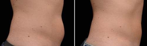 Miami Center for Cosmetic Dermatology – Dr. Deborah LongwillFreezing ...